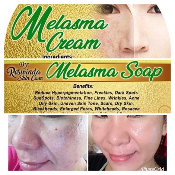 Melasma Remover | Makeup | Melasma Soap Cream Remove Dark Spot 0 ...